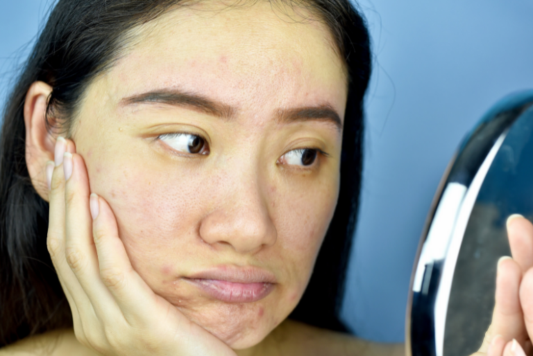 What Causes Dull Skin